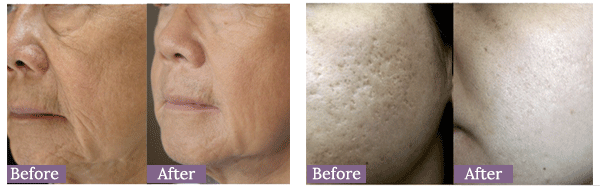 LifeScape Aesthetics New eTwo Device